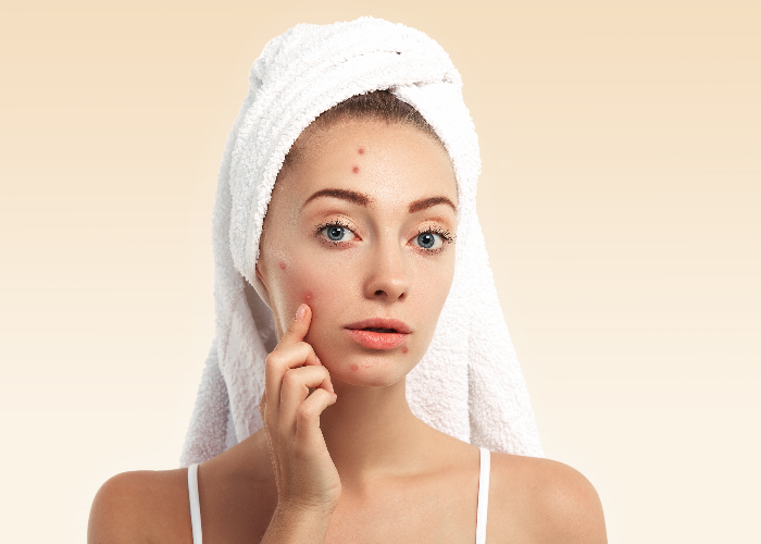 ¿Cuál es el mejor Tratamiento para el Acné? – MartiDerm Shop